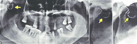 A C Panoramic Radiograph And Open And Close Right Tmj View Showing