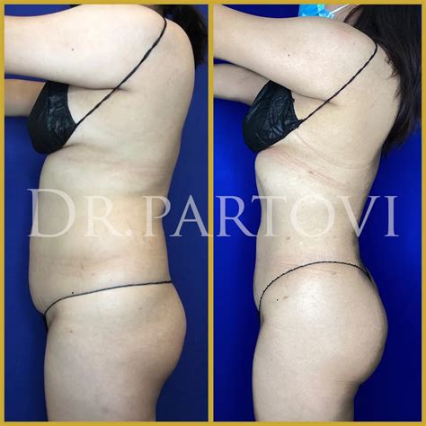 Brazilian Butt Lift Surgery In Culver City Ca True Jewel Surgical Center