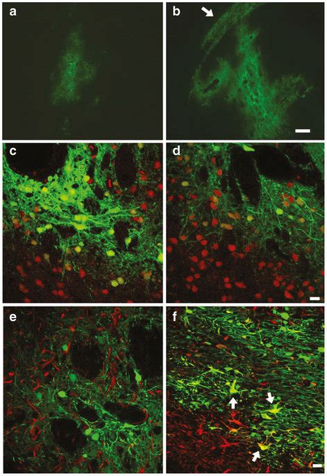 In Vivo Striatal Transduction By Integrating And Nonintegrating