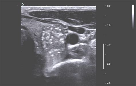Vietnamese Medic Ultrasound Case 338 Thyroid Cancer Dr Phan Thanh HẢi Medic Medical Center