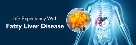 Understanding Life Expectancy With Fatty Liver Disease