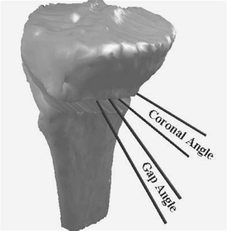 An Axial Cut Of The Proximal Tibia At The Metaphyseal Diaphyseal