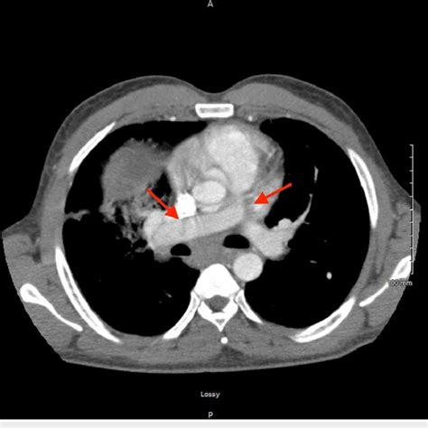 Ctpa Showing Bilateral Pulmonary Emboli Red Arrows Download