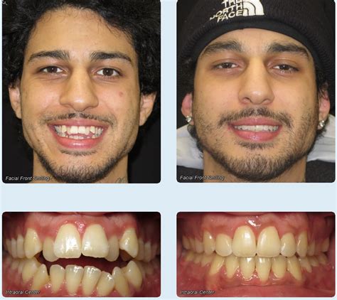 Overbite Before And After Pictures Orthodontic Before After Photos