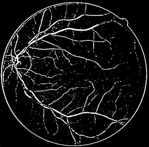 Retinal Image Pre Processing Wenhao Yu