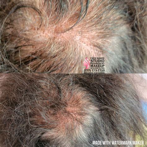 Scalp Beard Micropigmentation Face Naked Studio