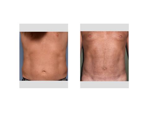 Plastic Surgery Case Study Abdominal Etching Liposuction Explore