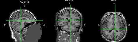 acpc alignment before freesurfer recon all freesurfer neurostars