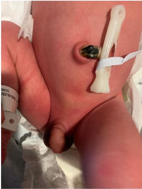 Medical Penile Constriction Ring