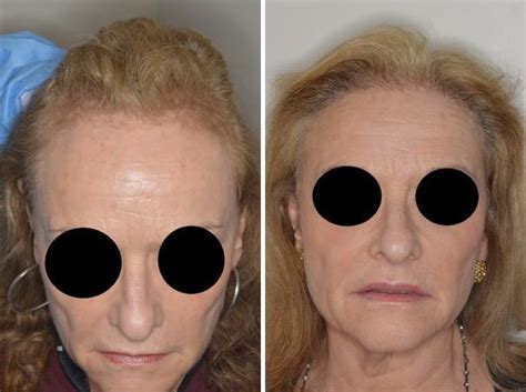 Hair Transplant Photos Miami Fl Patient 2709