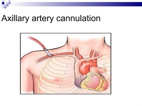 Cannulation Techniques During Cpb Ppt