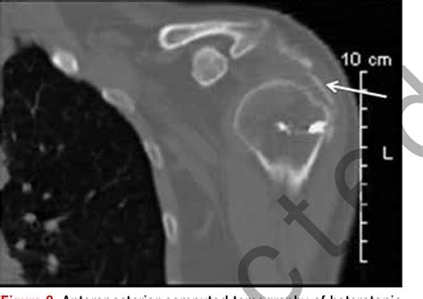 Figure 3 From Heterotopic Ossification Of The Deltoid Muscle After
