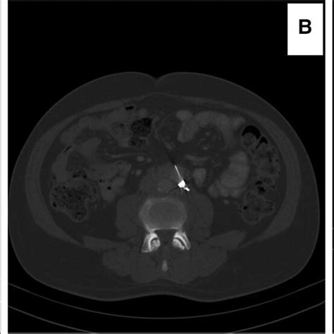 Computed Tomography Angiography CTA Images Illustrating A