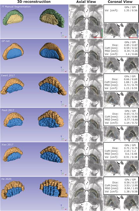 Segmentation And 3d Reconstruction Of The Gp Of A Representative Pd Download Scientific Diagram