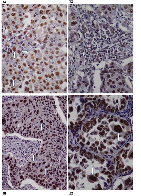 Association Of Foxp3 Expression With Non Small Cell Lung Cancer