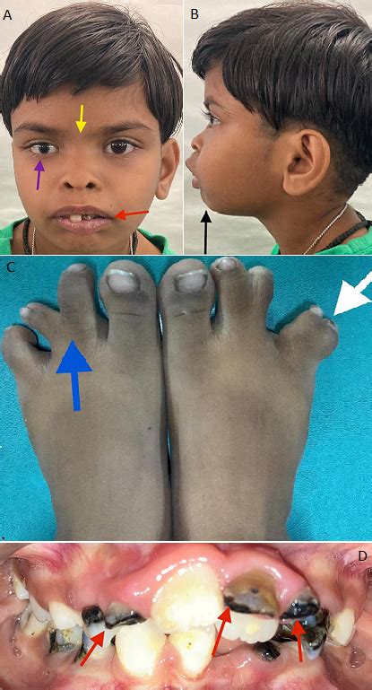 Oral Facial Digital Syndrome