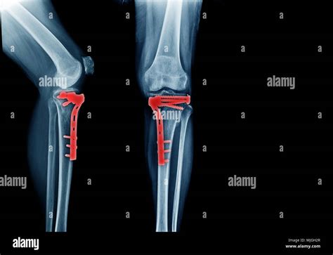 Tibia Fibular Fracture Hi Res Stock Photography And Images Alamy