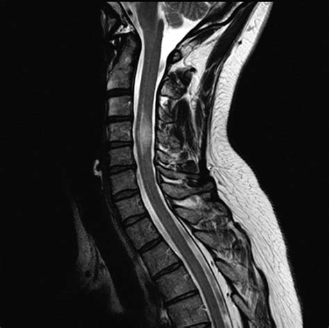 Myelogram Spinal Imaging • American Health Imaging • X Ray