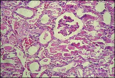 Glomerular Atrophy And Acute Tubular Necrosis Of Renal Section In Gm