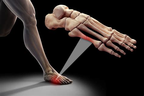 Metatarsal Stress Fracture