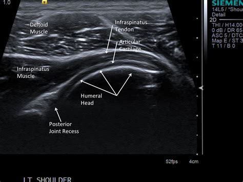 Shoulder Arthrogram Injection