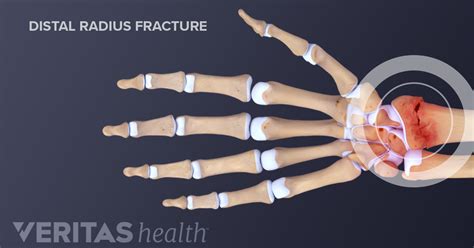 Broken Wrist Distal Radius Fracture