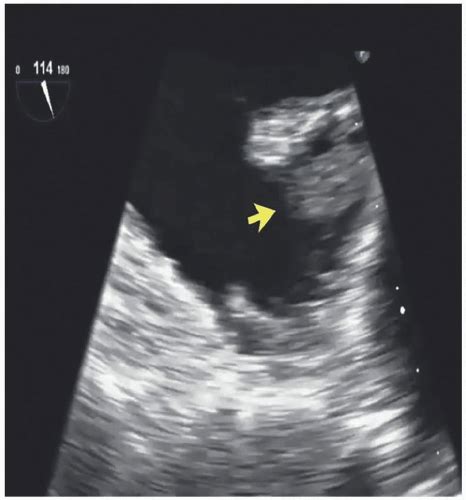 The Left Atrium And The Left Atrial Appendage Thoracic Key