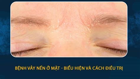 Bệnh Vảy Nến ở Mặt Biểu Hiện Và Cách điều Trị