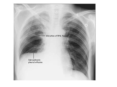 Diagnostic Imaging Of Pleural Lesions