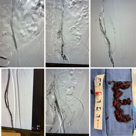 Jose Hernandez On Linkedin Great Thrombectomy Procedure With Extensive Clot This Was No
