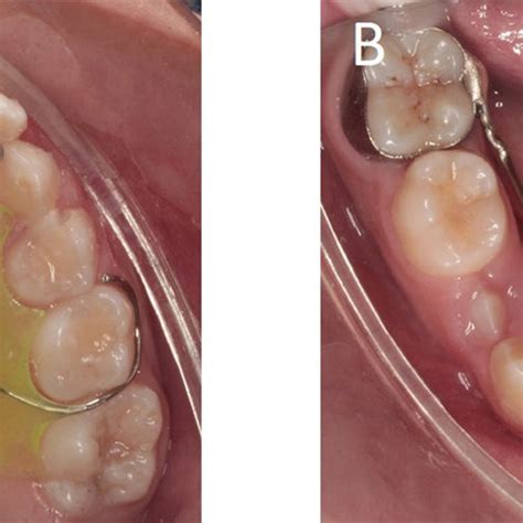 A Acrylic Plate With Springs B Mandibular Lingual Holding Arch