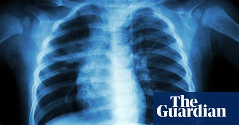 Kansas Officials Say Tuberculosis Outbreak Is Largest On Record In Us History
