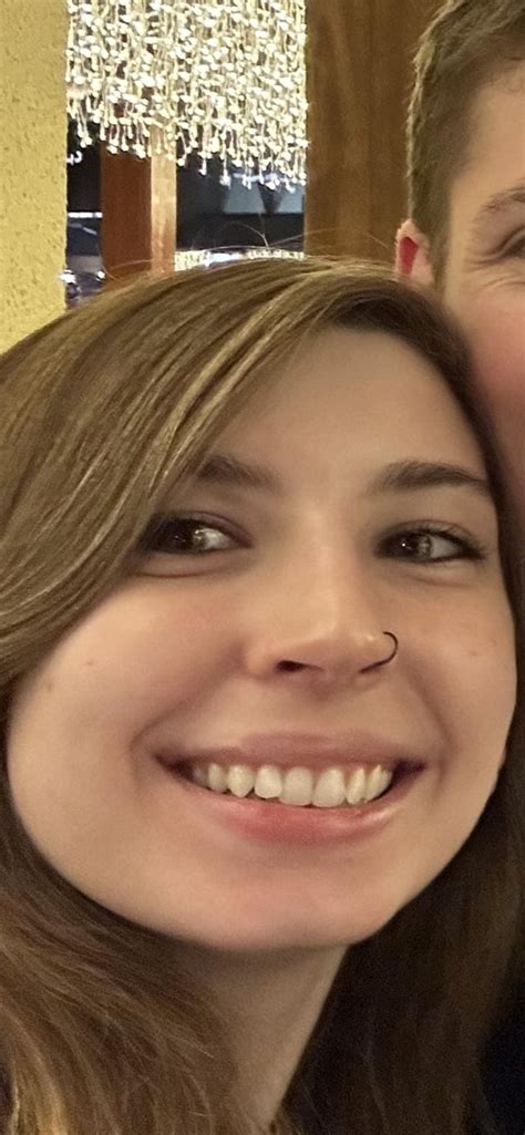 Lip Scar Treatments Rcosmeticsurgery