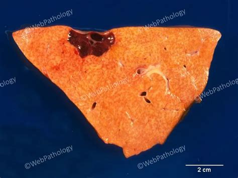 Liver Hemangioma Gross Pathology