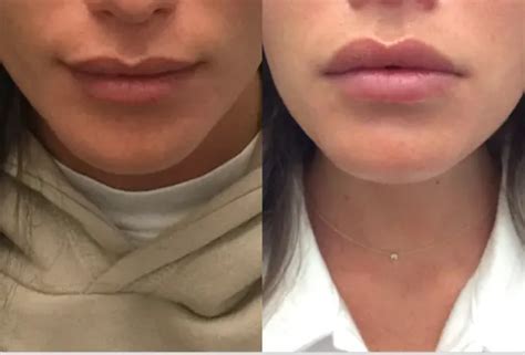 the ultimate guide to lip flip before and after results flash uganda