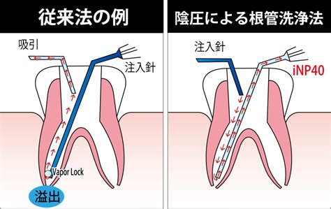 エンド専門医の吉岡隆知先生に学ぶ！根管治療の成功率を決める効果的な根管洗浄法 Ci セミナー開催情報