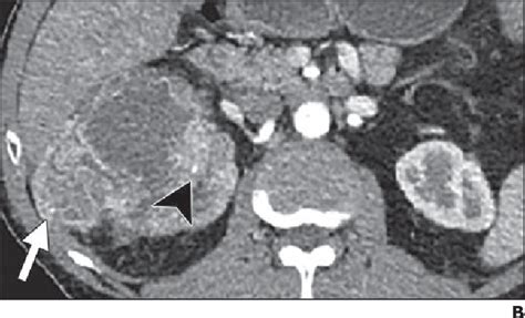 Figure 3—68 From Diagnosis Of Sarcomatoid Renal Cell Carcinoma With Ct