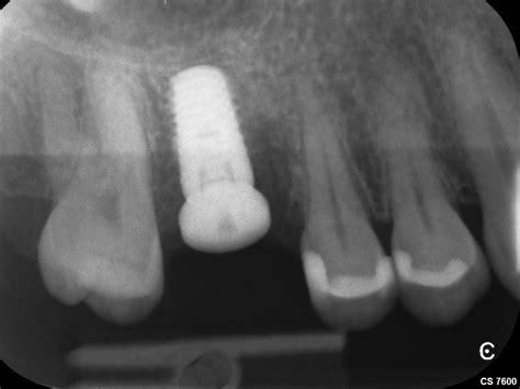 Immediate Implant 3 Cases And Questions Osseonews