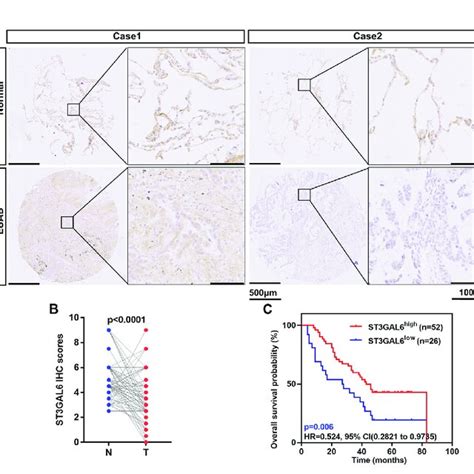 Low Expression Of St Gal In Luad Patients Is Associated With A Poorer