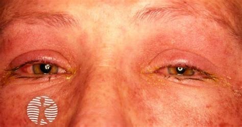 Sjs Ten Ocular Image