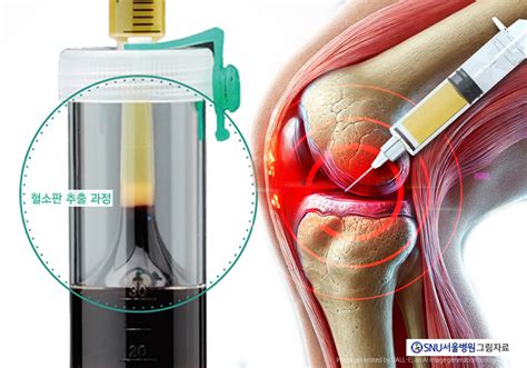 Snu서울병원 신의료기술 무릎 퇴행성관절염 Prp 주사치료 시행