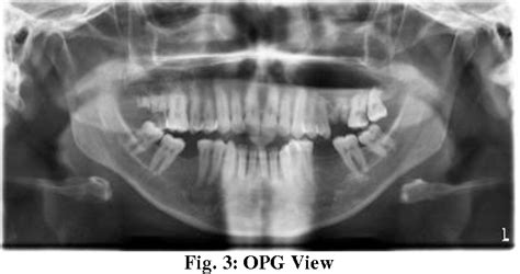 Figure 3 From Two Way Approach For Enucleation Of Maxillary Radicular