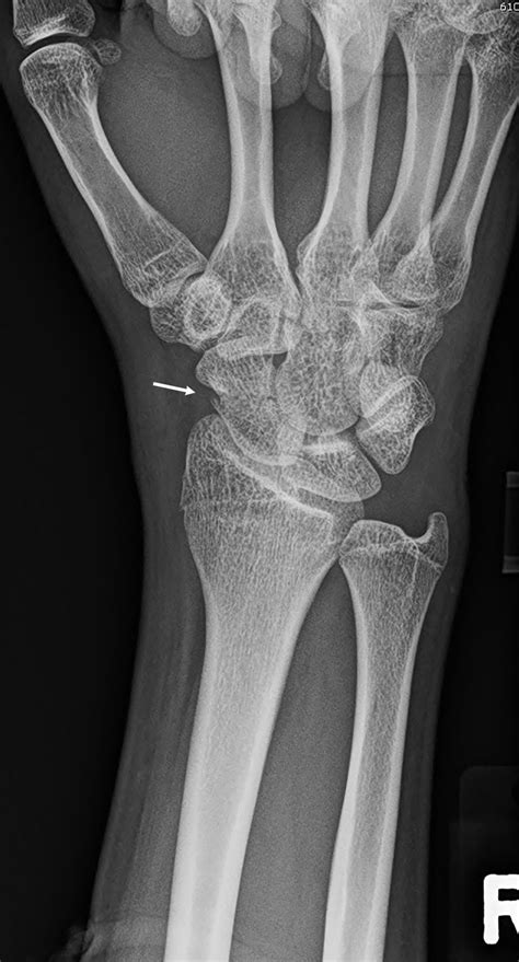 Snuffbox Scaphoid Fractures Radiology Key