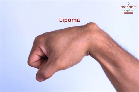 Understanding Lipoma Causes Symptoms And Treatment Pranaam Hospitals