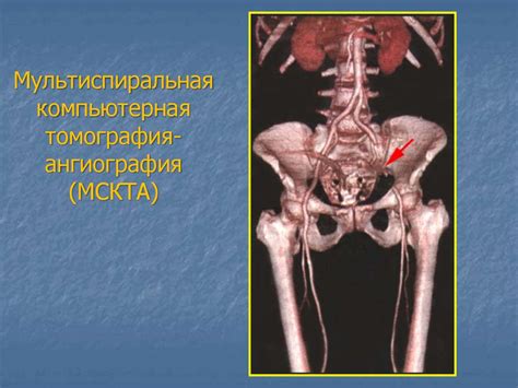 Хронические облитерирующие заболевания артерий нижних конечностей
