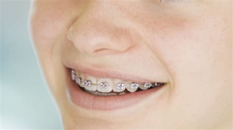 Fashion Braces The New Big Trend Glamour