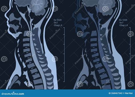 Mri Of The Cervical Spine With And Without Contrast Mri With Bilateral