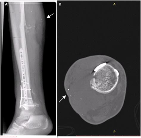 What Does Sarcoma Look Like On X Ray