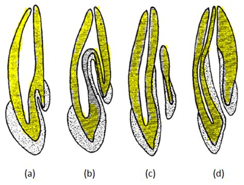 Full Text Collaborative Endodontic And Surgical Management Of A Type