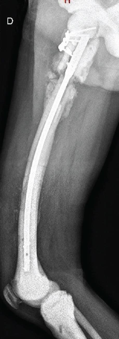 Postoperative Anteroposterior A And Lateral B Radiographs Of The